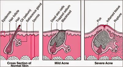 What causes Acne and its stages , skin treatment « Treatment Institute