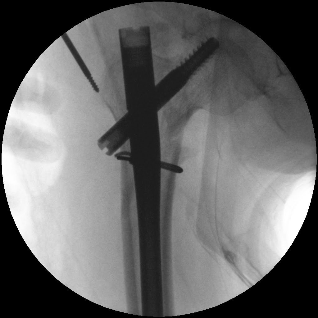 Diario De Practicas: CLAVO ENDOMEDULAR DE FÉMUR CON IJNERTO DE HUESO