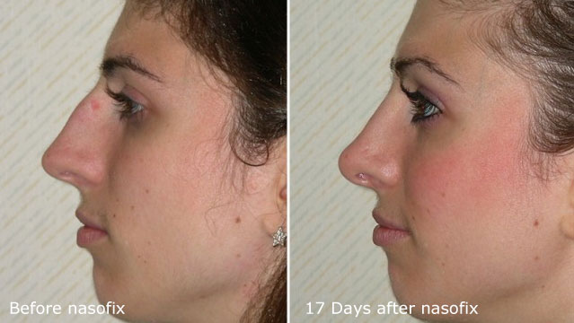 Reviews and Rants: Nasofix Review - Before and After Nasofix UPDATE