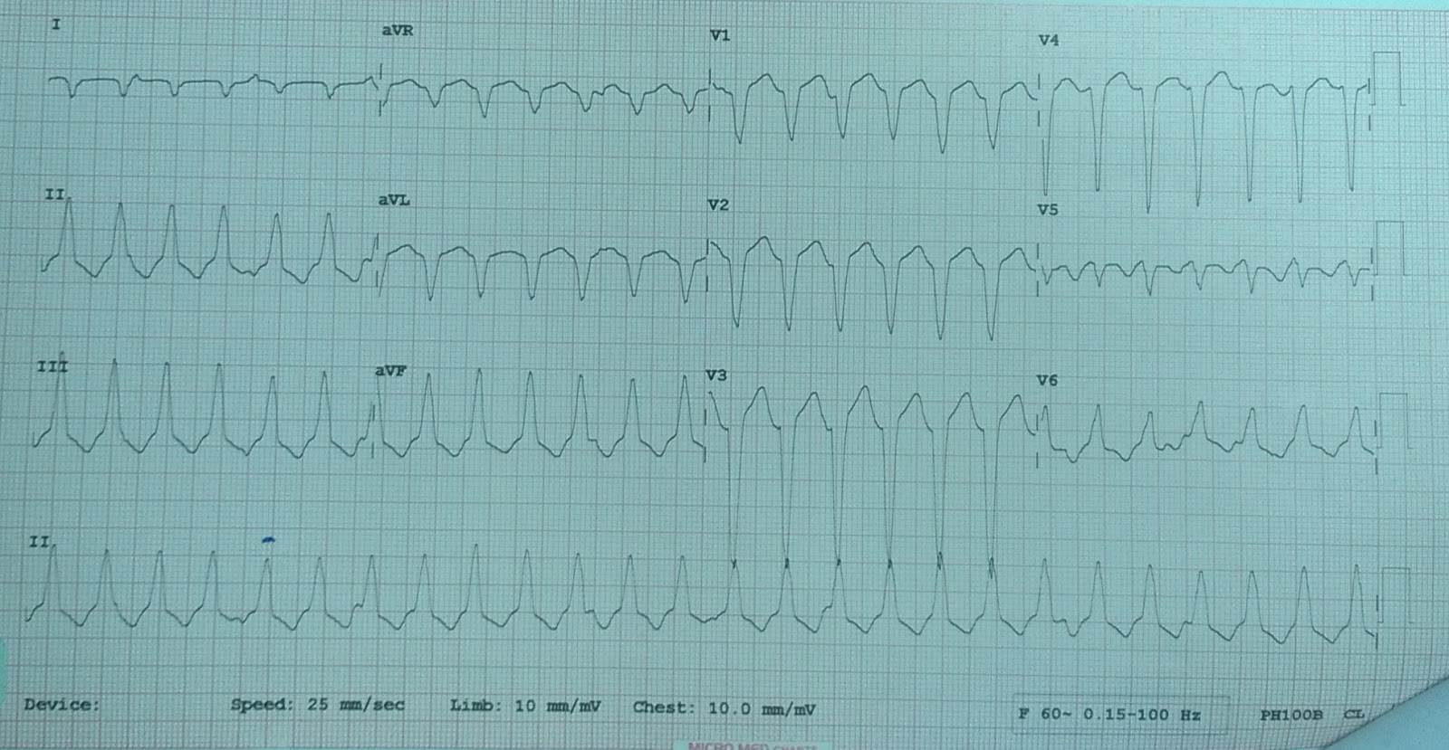 Cardiology window: Monomorphic Ventricular tachycardia ? What is your ...