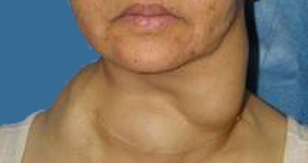 Gejala Penyakit Tiroid Pada Wanita - Perumperindo.co.id