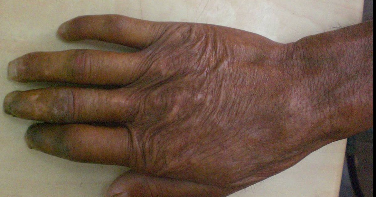 Phimaimedicine: 1,015. Acroosteolysis