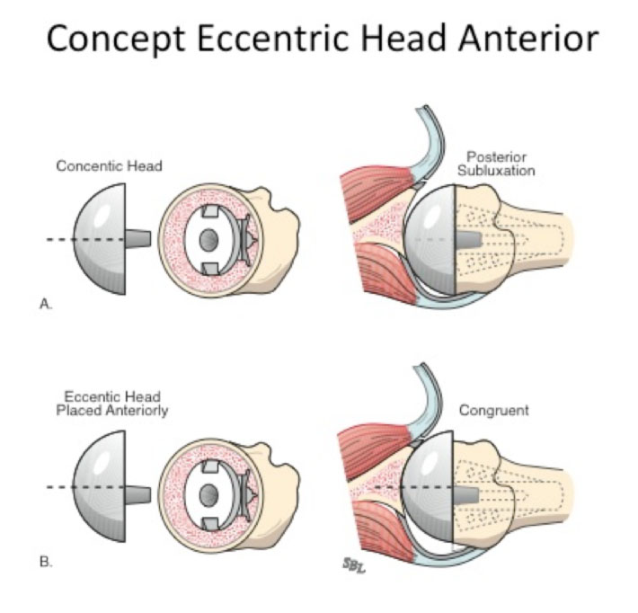 UW Shoulder and Elbow Academy: Shoulder joint replacement step by step ...