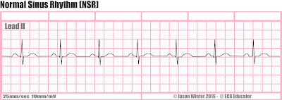 ECG Educator Blog : Six Second ECG Rhythm Strips