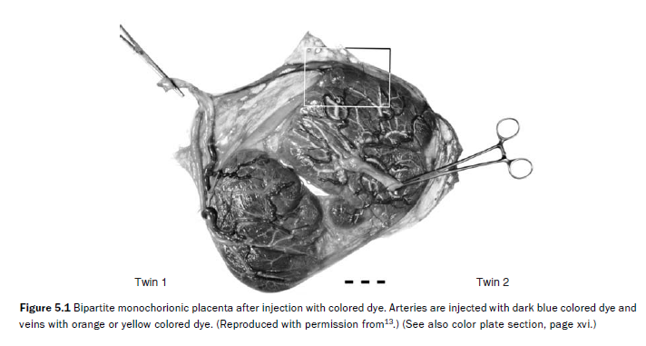 Zygosity | Twin-Twin Transfusion Syndrome (TTTS)