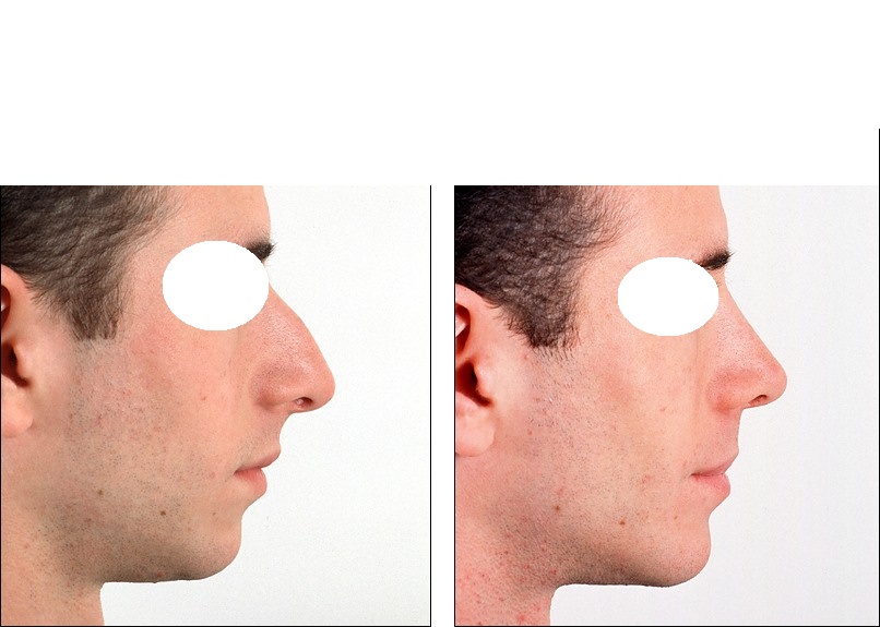 Rinoplastia rinoplasty rhinoplasty nose job Clinica Arroyo Goldstein ...