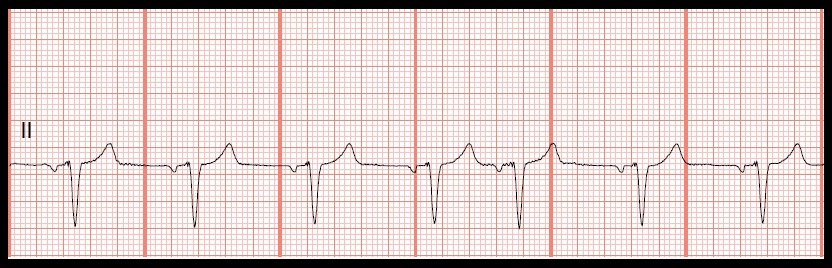 EKG Rhythm Strip Quiz 168