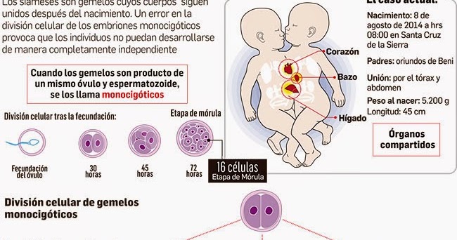 Los siameses nacen por falla en la mutación del embrión | Diagnostico ...