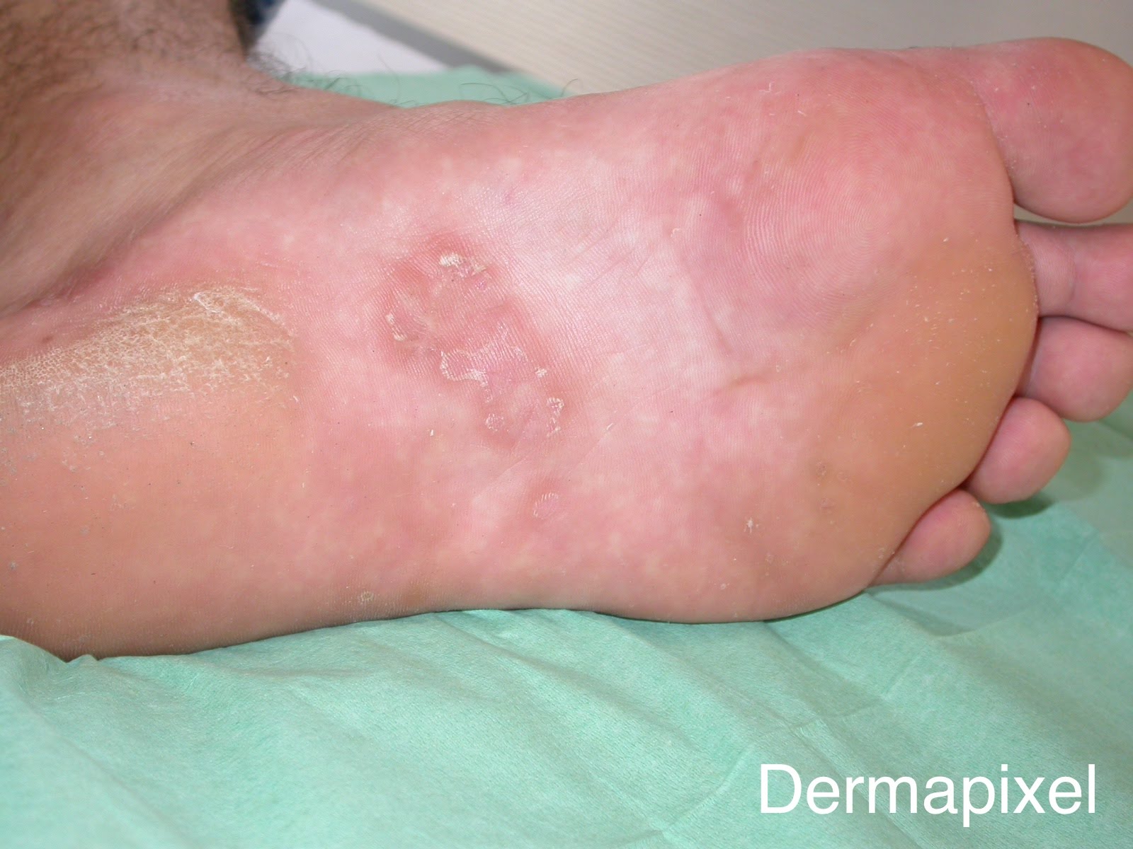 Dermapixel: febrero 2018