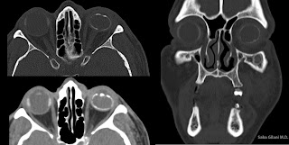 Roentgen Ray Reader: Phthisis Bulbi