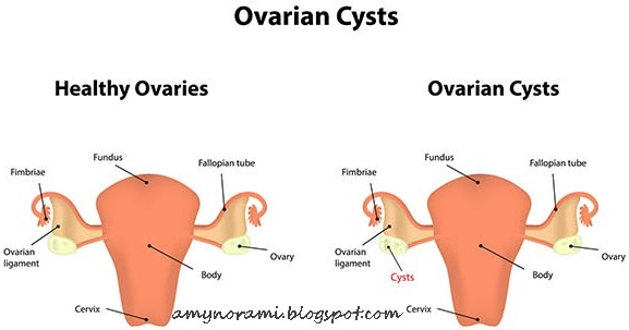CYST : Cyst Kecut Bila Amalkan Cecair Merah - amynorami.com
