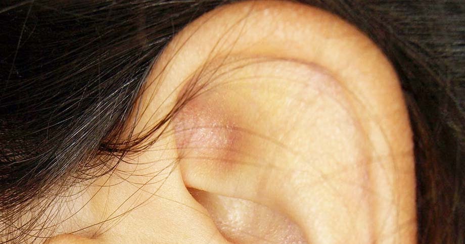 Ear Skin Tags in Babies and Their Removal | Fauquier ENT Blog