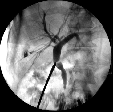Exames Contrastados - COLANGIOGRAFIA