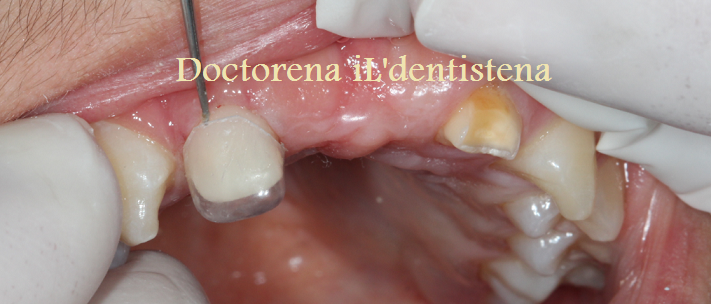 My Dental Diary: Strip Crowns