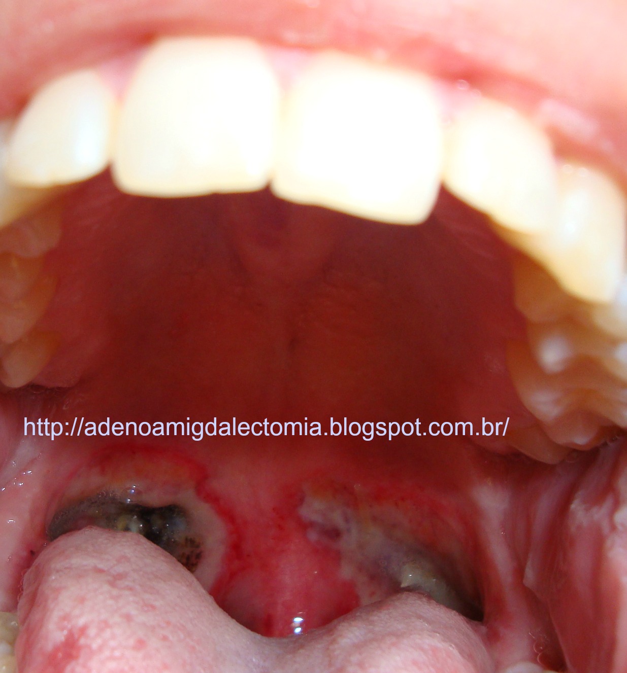 Adenoamigdalectomia: Foto Adenoamigdalectomia: Segundo Dia