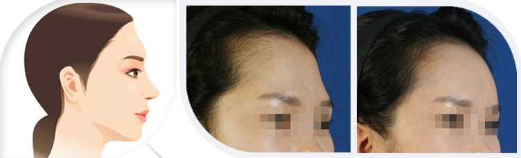 BK Plastic Surgery: [BK Plastic Surgery] Facial bone contouring ...