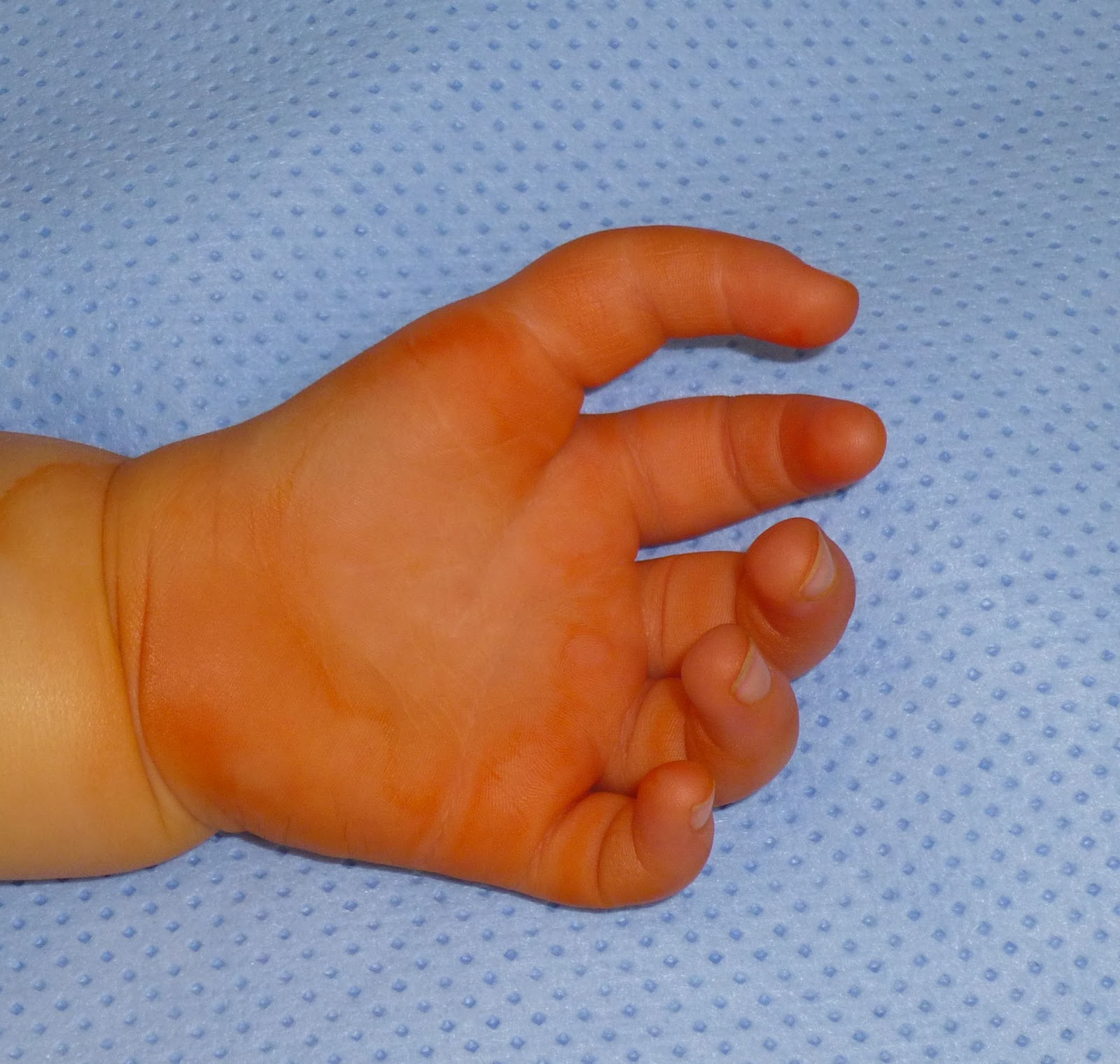 The 5- Finger Hand | Congenital Hand and Arm Differences | Washington ...