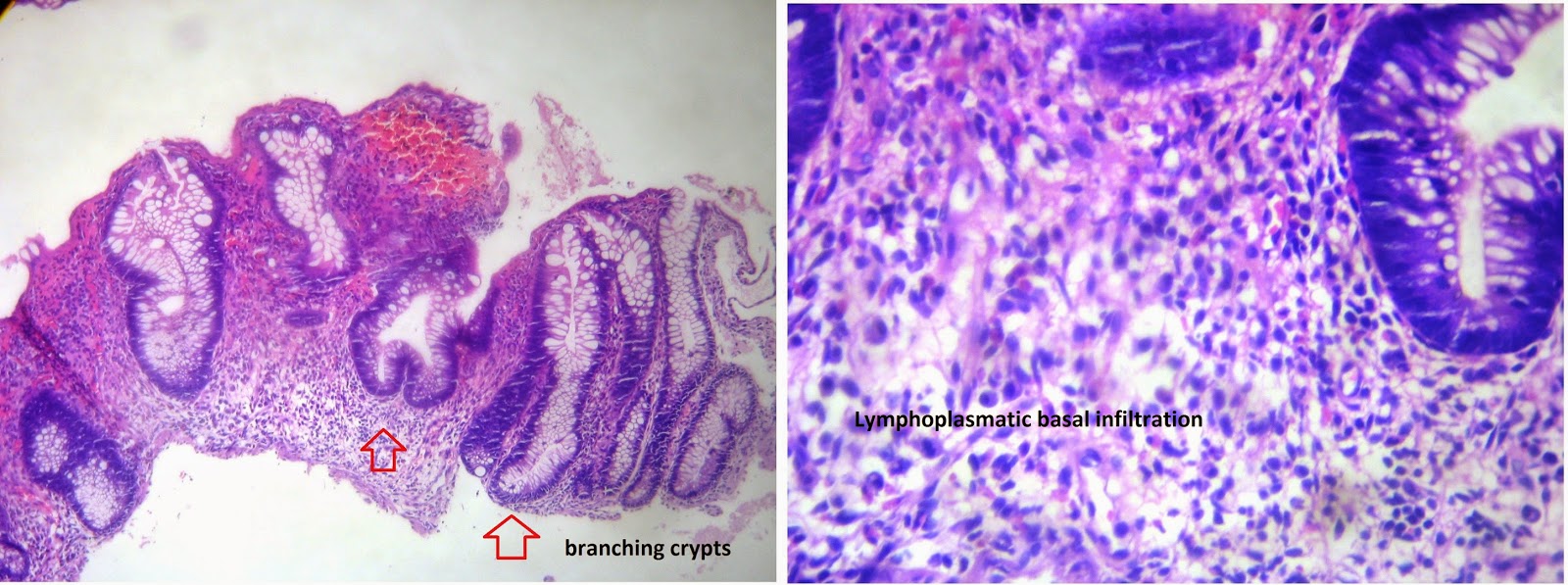 GASTROINTESTINAL AND LIVER HISTOLOGY PATHOLOGY ATLAS: COLON: ULCERATIVE ...