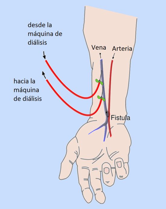 Nefrologiaysalud: La hemodiálisis como opción para todos