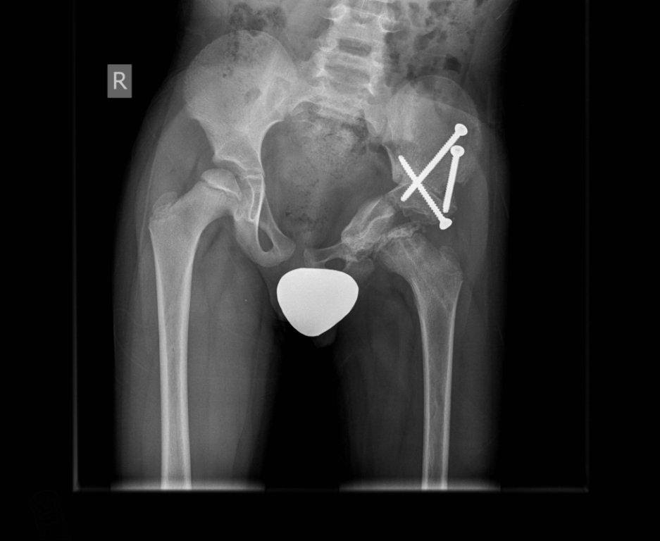 Jeremy s Journey With Legg Calve Perthes Disease What Is Legg calve Jeremy s Journey With Legg Calve Perthes Disease What Is Legg calve