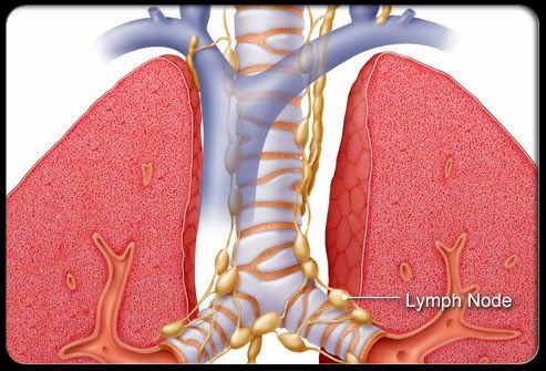 Causes, Symptoms, Treatment, and Prognosis of Stage IV Lung Cancer ...