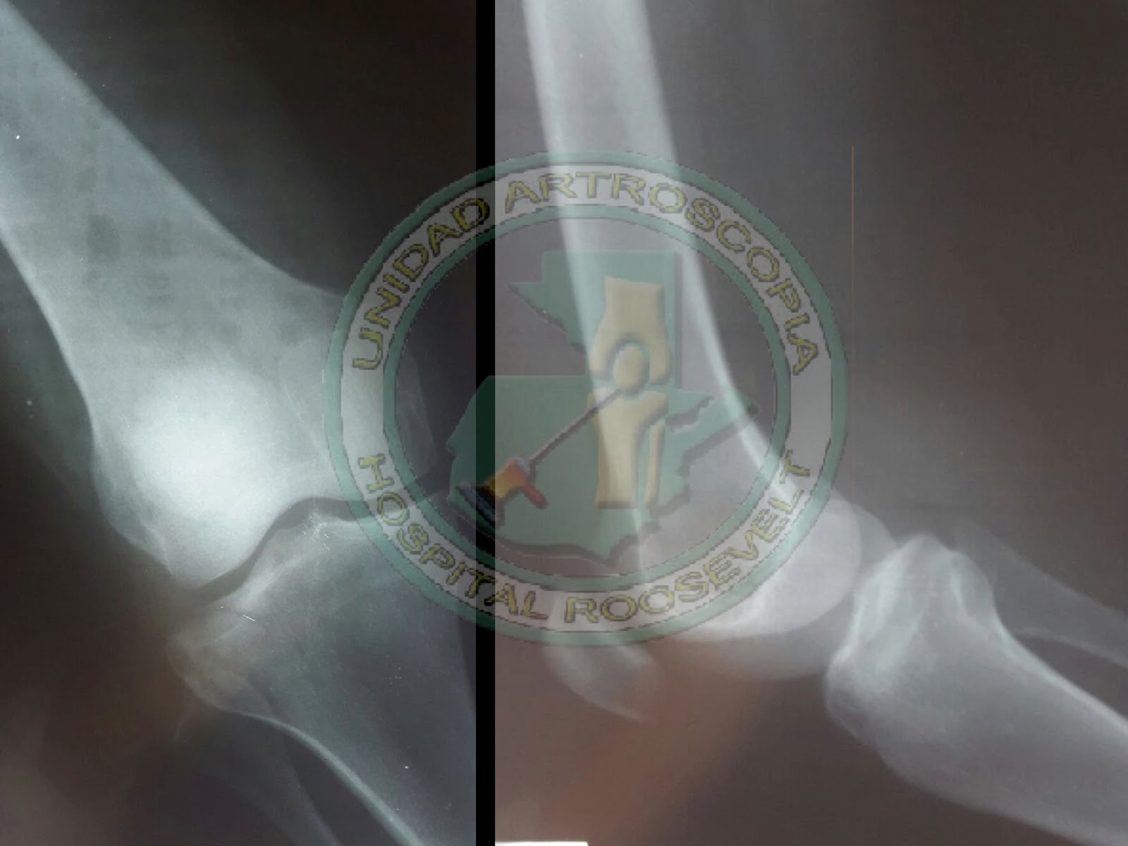 Unidad de Artroscopia: ESPINA TIBIAL