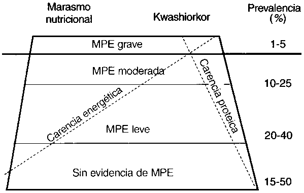 Desnutricion Infantil: Marasmo