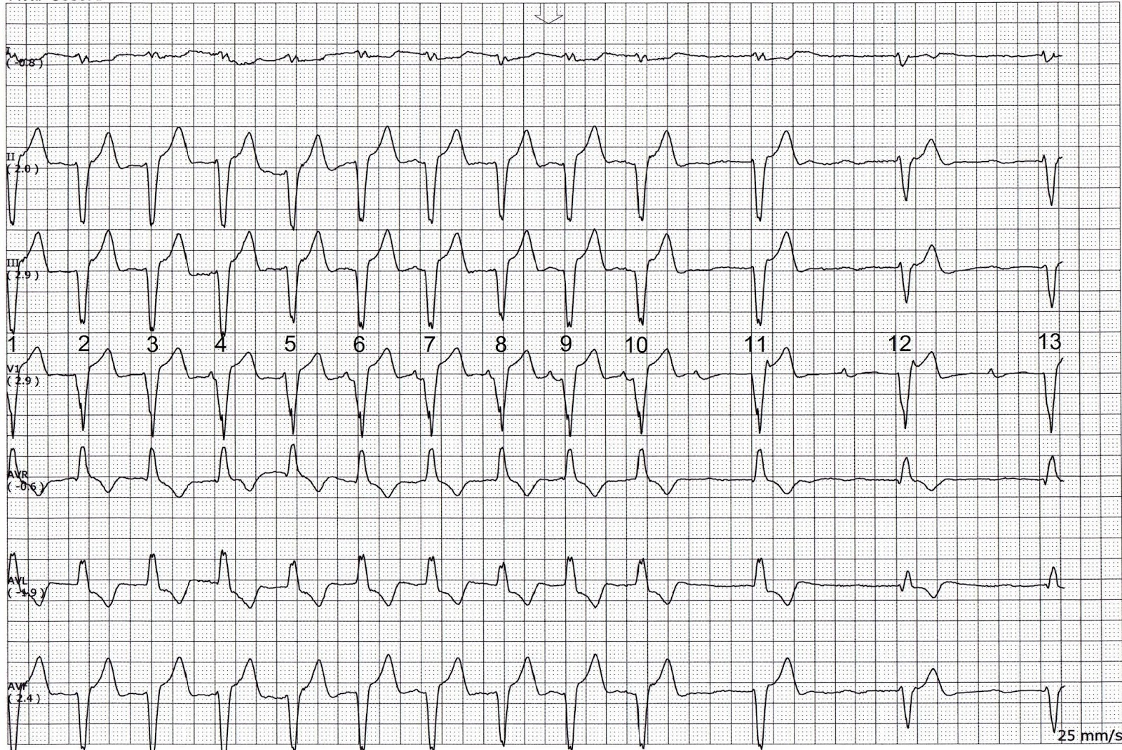 ECG Rhythms: The "skipping" P waves