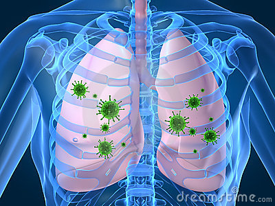 INFECÇÃO PULMONAR - O que é, como identificar e como é o seu tratamento ...