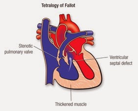 Decreased Cardiac Output - Tetralogy of Fallot Care Plan - Nanda Care Plan