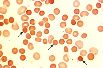 EL RINCÓN DE LA MEDICINA INTERNA: Frotis de sangre periférica. Esferocitos.