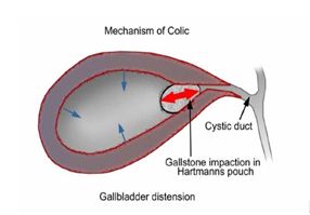 Dr Herry Setya Yudha Utama SpB. FInaCS. MHKes. ICS: abdominal colic ...