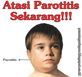 Obat Parotitis Atau Gondongan Terbaik ~ Pusat AgaricPro