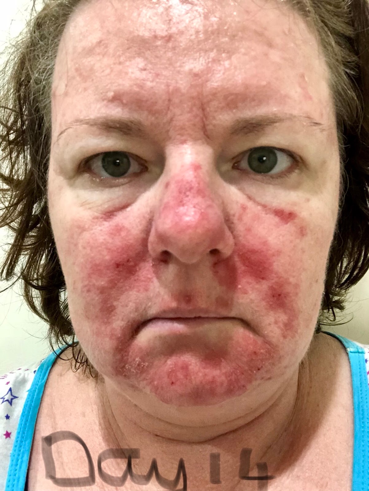 Efudix Treatment November 2018