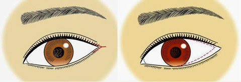 Dr. Lee Breast augmentation Korea: Lateral Canthoplasty - Relocating ...