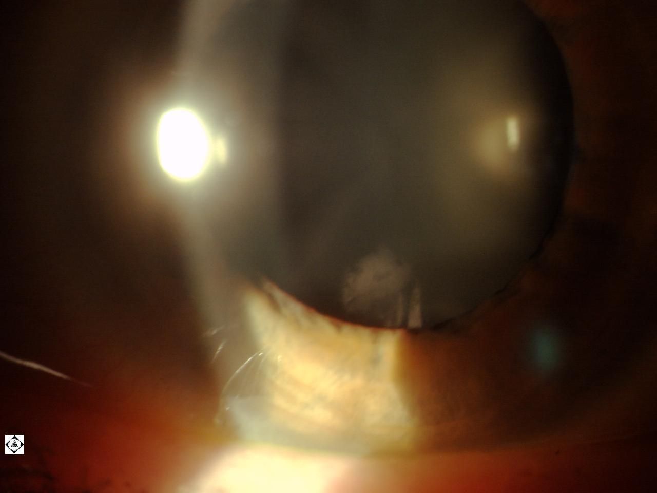 Sonoran Desert Eye Center: SMALL CORTICAL CATARACT