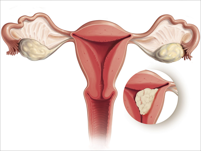 Signs Symptoms Of Uterine Cancer signs-symptoms-of-uterine-cancer
