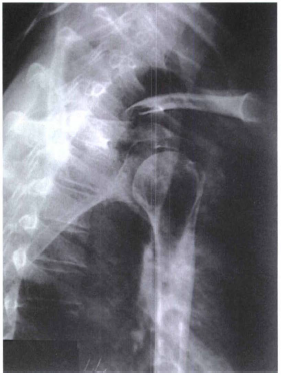 TRANSTHORACIC LATERAL SHOULDER (TRAUMA) | Radiology Basics | Radtechonduty