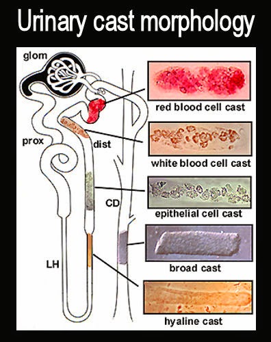 Medical Laboratory and Biomedical Science: Urinary cast morphology