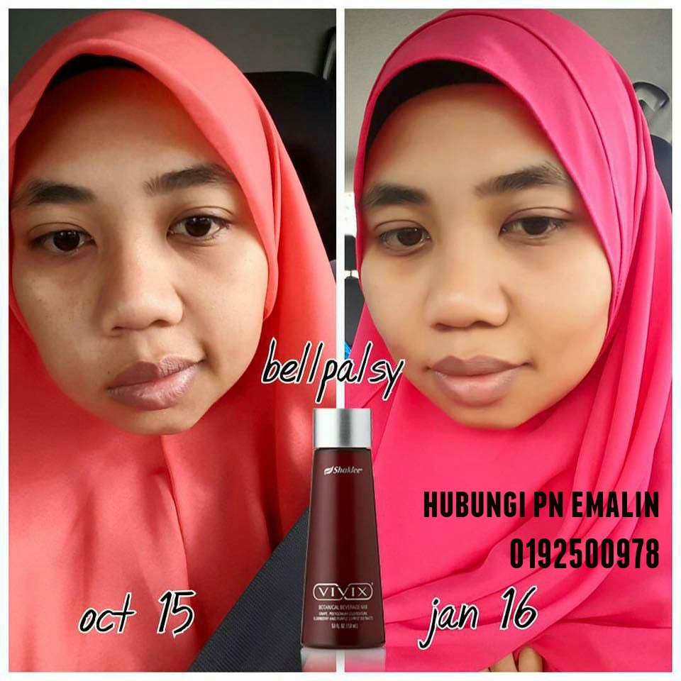 Pengalaman Menghidap Bell's Palsy Sehingga Muka Senget Sebelah Dan ...