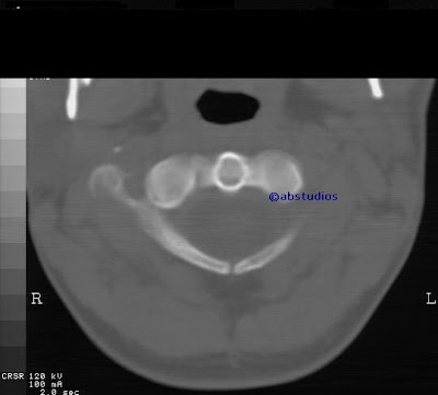 radiology cases: unfused posterior arch of atlas (c1) in a 30 year old male