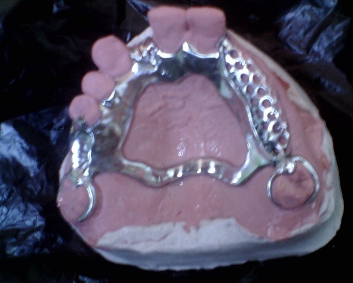 FER-DENTAL-LAB: PPR METALICAS