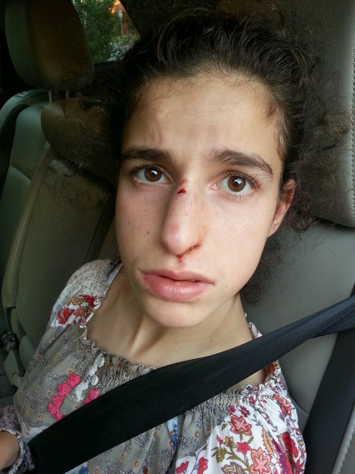 a moon, worn as if it had been a shell: The Face of Epilepsy