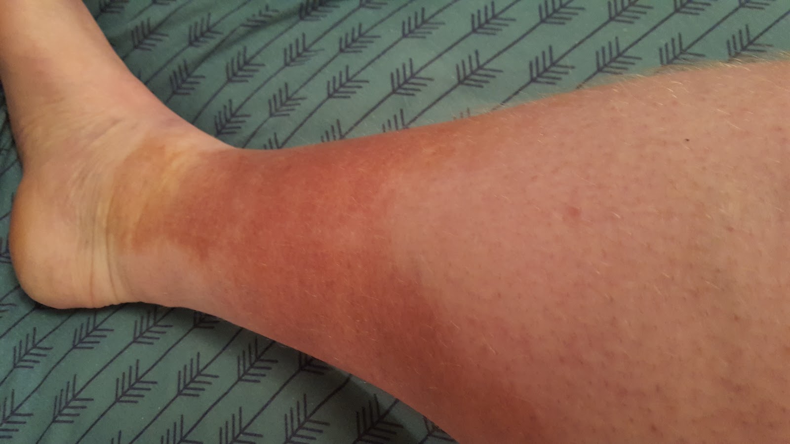 BubbaMike's Ramblings: Cellulitis (warning, graphic photos in this post)