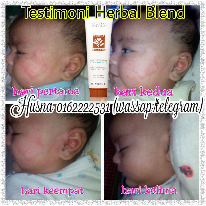 Krim berkesan dan cepat hilangkan ruam susu pada bayi - Cantik Sihat Corner