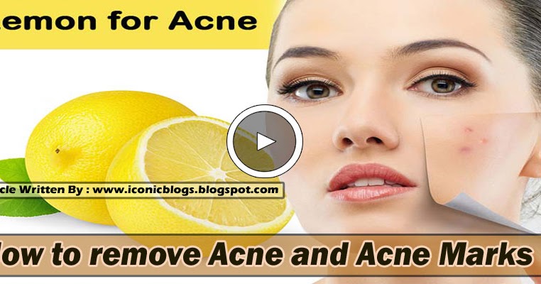 How To Remove Acne And Acne Marks - Iconic | Blogs