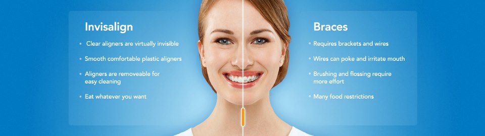 PEARL DENTAL JB: HOW DOES INVISALIGN WORK?