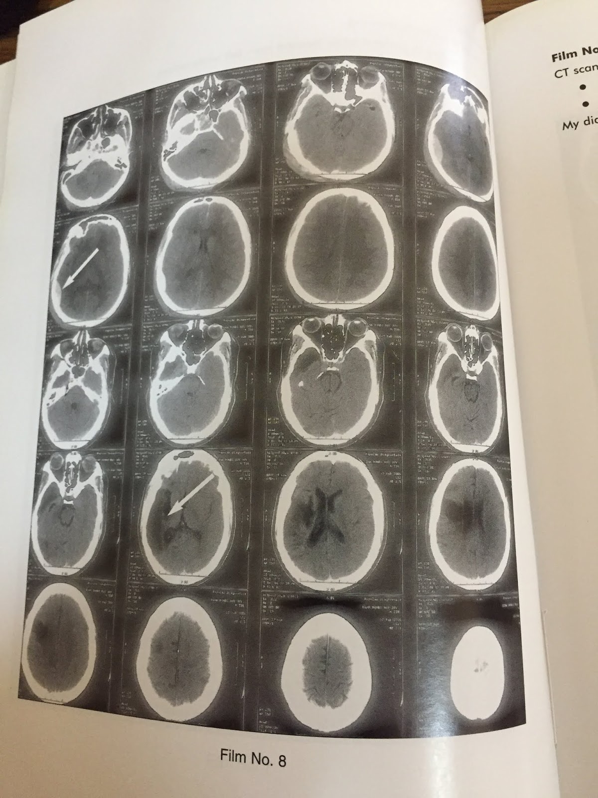 CT SCAN OF BRAIN-4