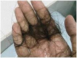 Selamat Datang Di Klinik Jerry: 22. Penyakit Rambut Rontok Dan ...