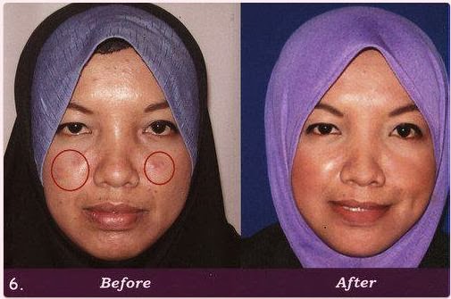 CARA MENGHILANGKAN KUTIL DI WAJAH